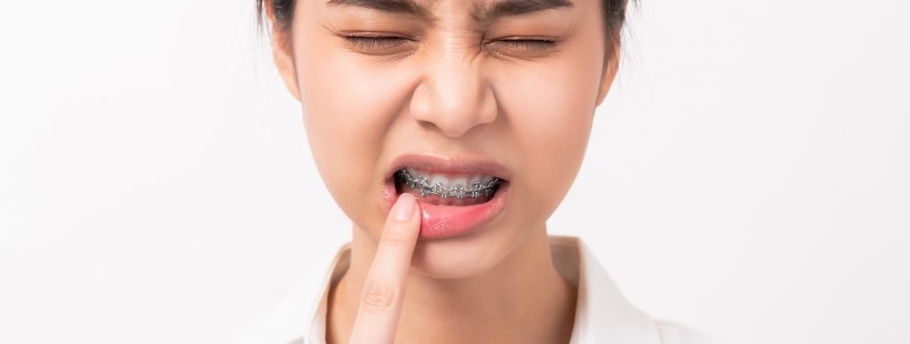 Learn What to do When Your Braces Cause Painful Mouth Ulcers