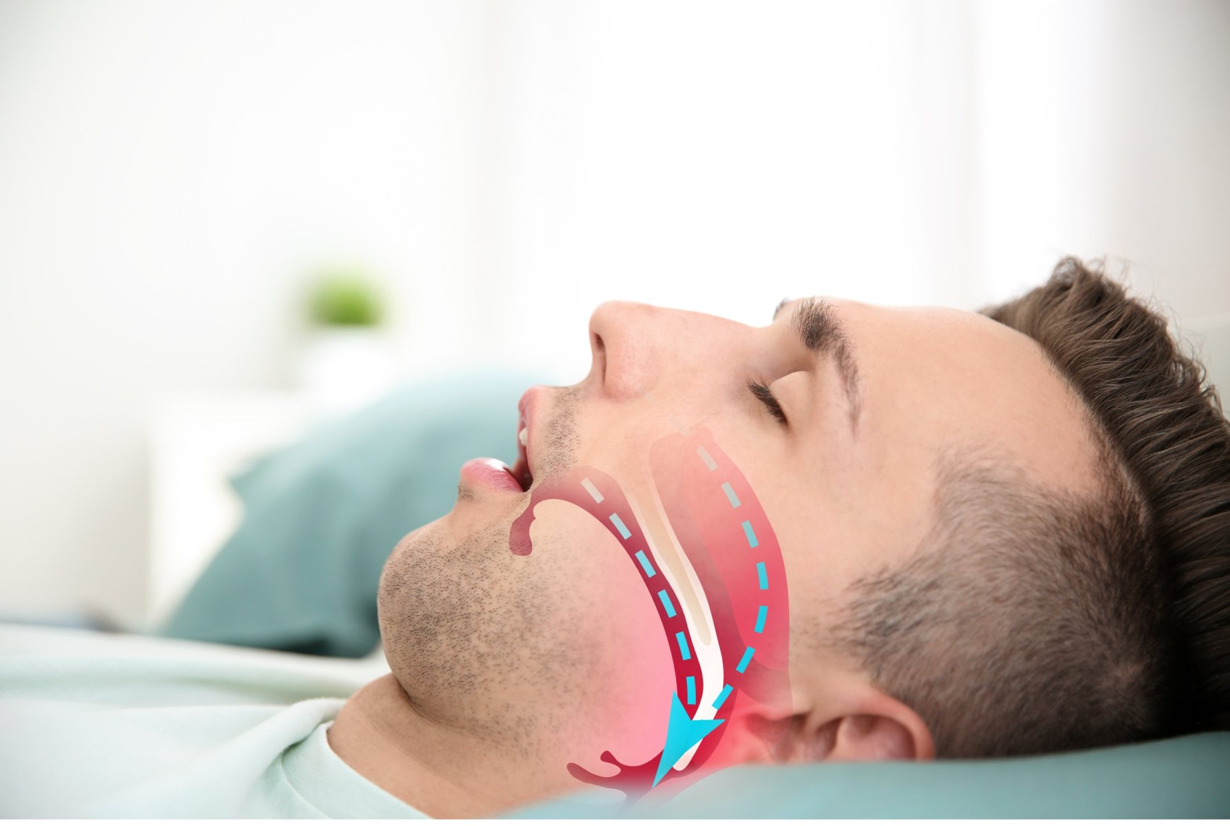Oral Surgery for Sleep Apnea | Empire Dental
